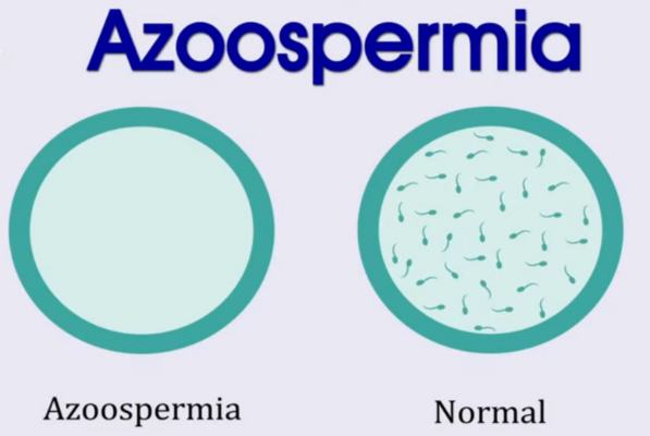What is Azoospermia: Symptoms, Causes, and Treatment - Sunrise IVF